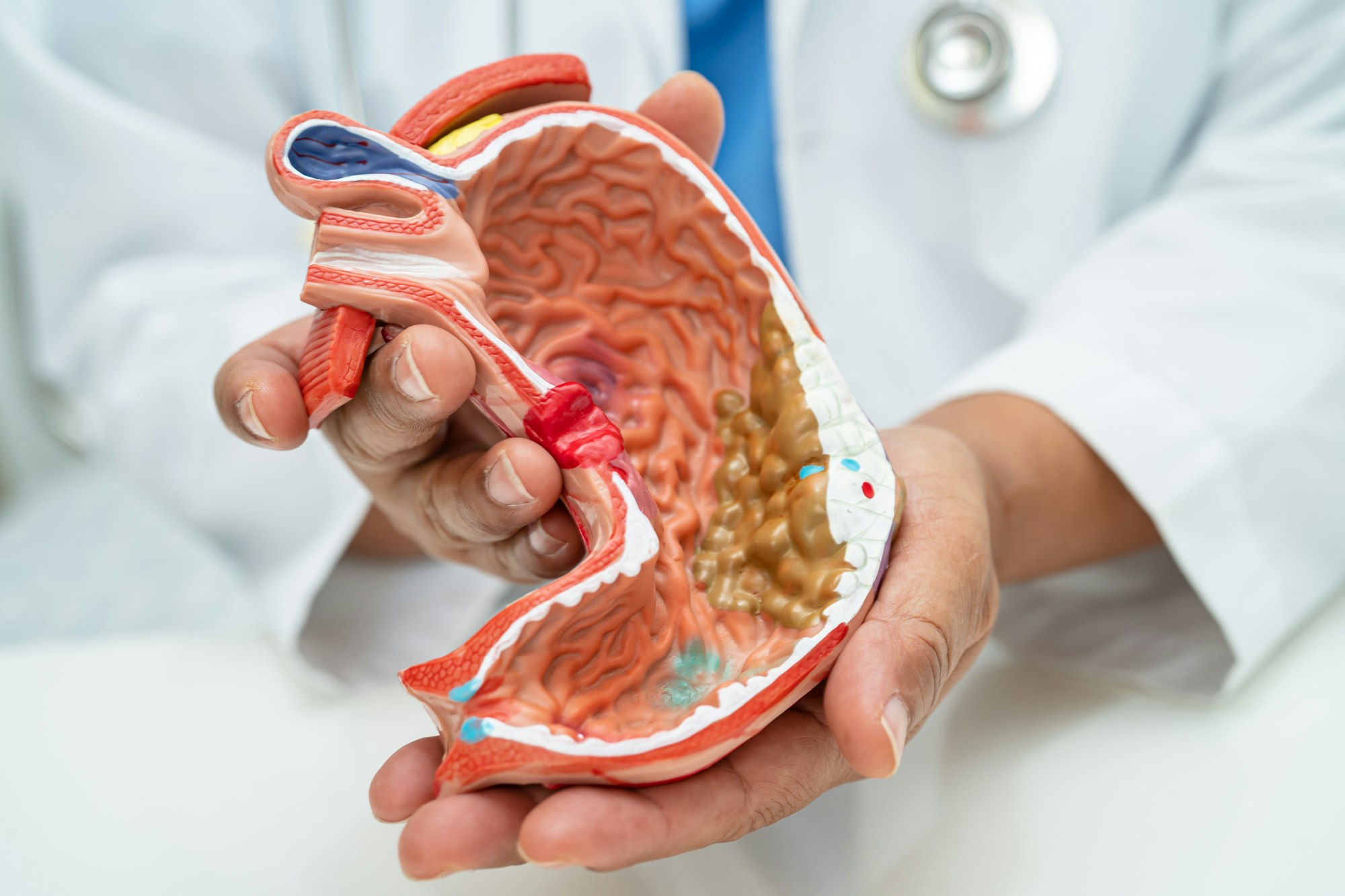 Hernia Paraestomal en Madrid | Instituto MediQ