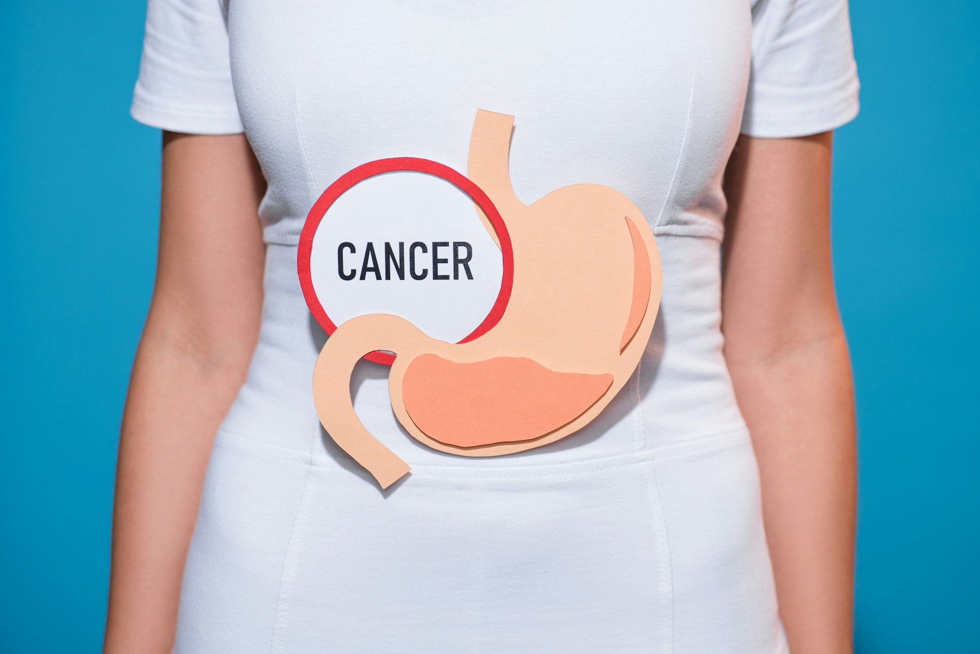 Cáncer de Estómago en Madrid | Instituto MediQ